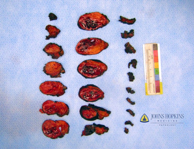 Pheochromocytoma Surgical Pathology Photo Website