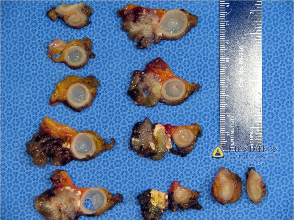 Appendix Surgical Pathology Photo Website